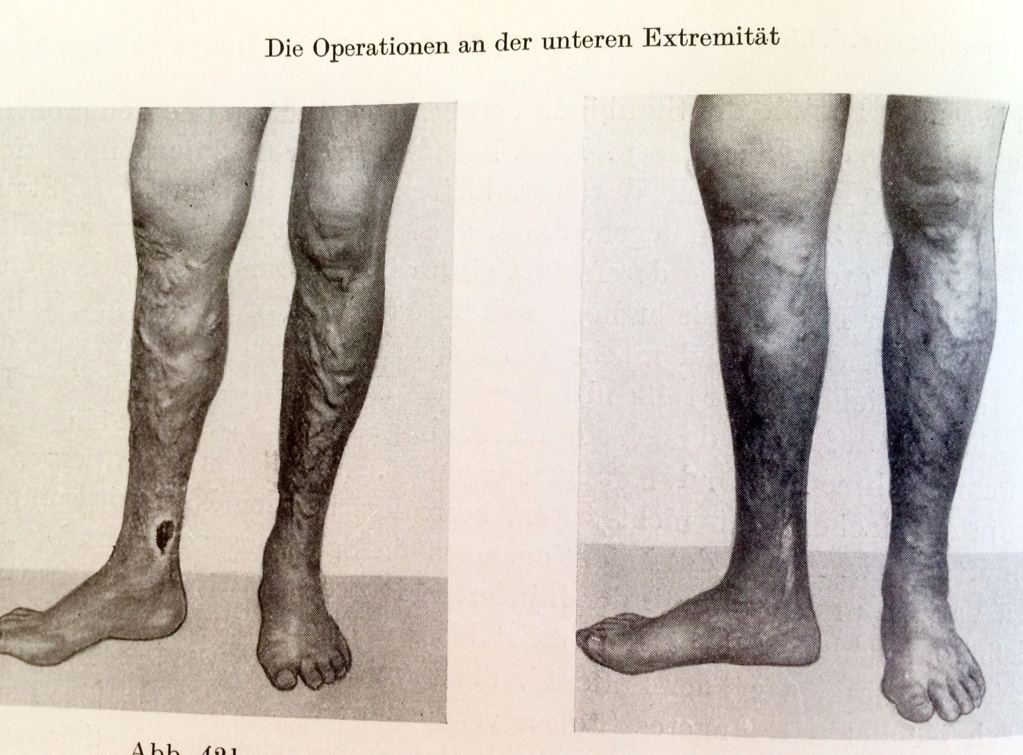 Venöse Durchblutungsstörungen - unbehandelt ein hohes Risiko! - Saphenion
