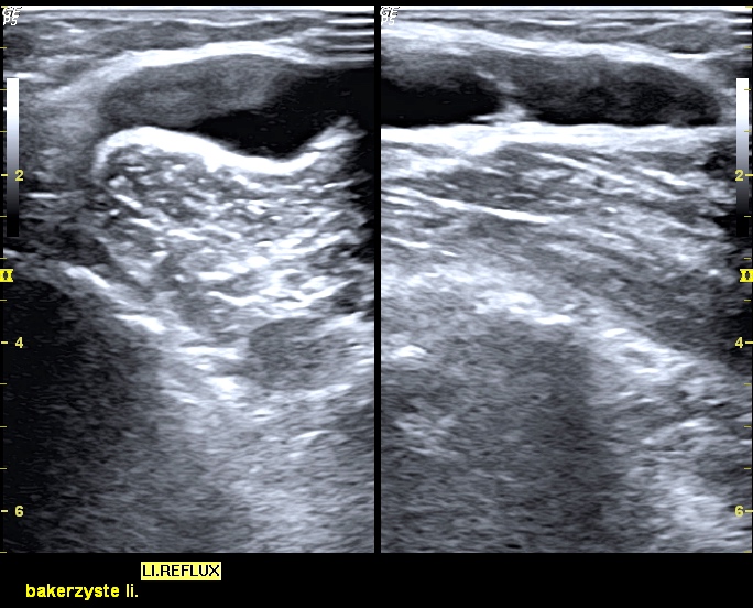 Saphenion®: Therapieprotokoll Bakerzyste - die RFITT-Methode