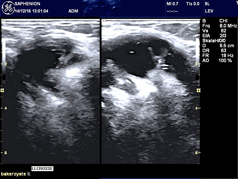 Saphenion®: Therapieprotokoll Bakerzyste - die RFITT-Methode