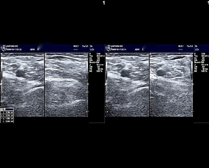 Saphenion®: Therapieprotokoll Bakerzyste - die RFITT-Methode