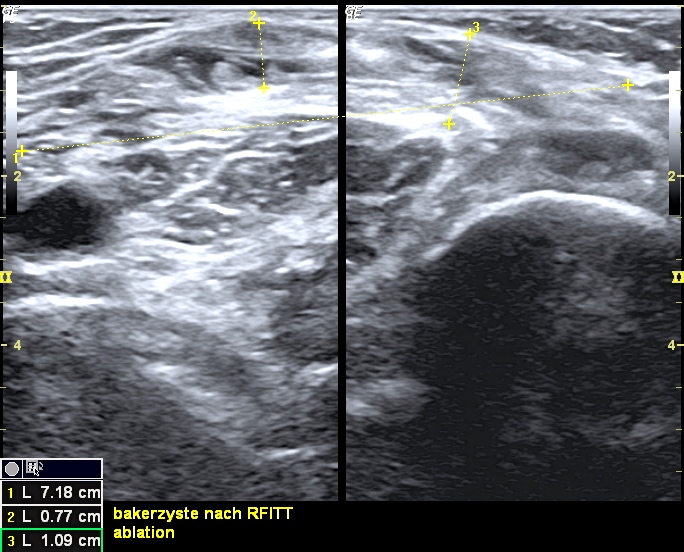 Saphenion®: Therapieprotokoll Bakerzyste - die RFITT-Methode