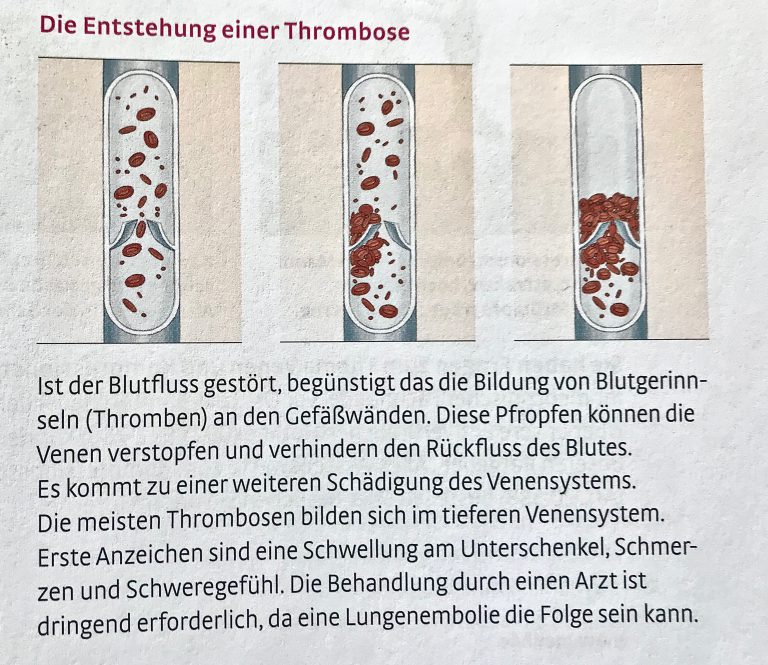 Saphenion®: Tiefe Beinvenenthrombosen