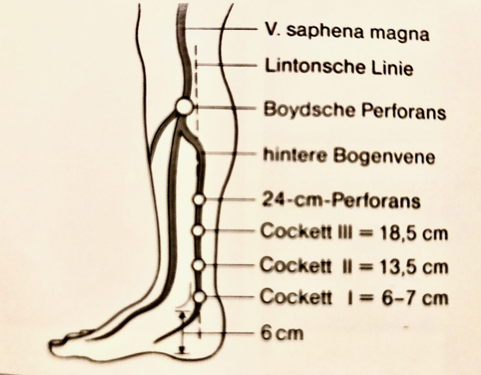 Saphenion® - Therapie von Perforanzkrampfadern mit Venenkleber