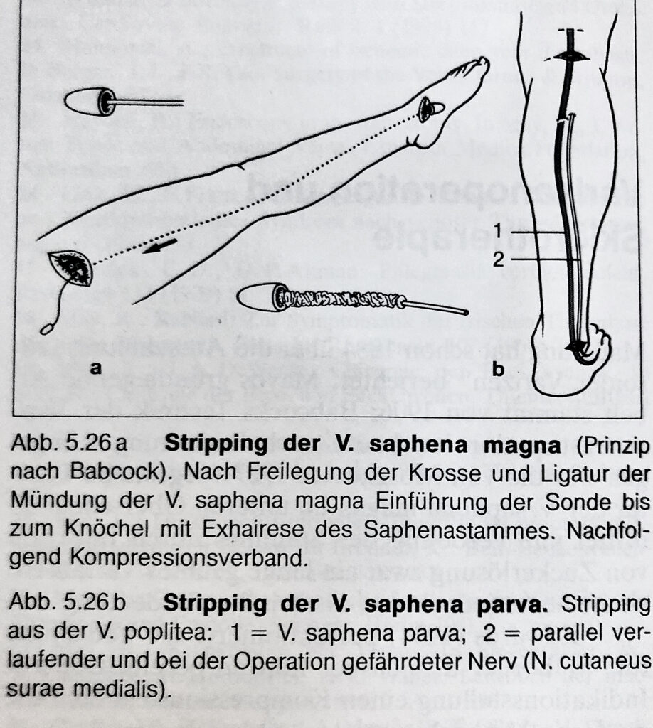 Saphenion®: Nebenwirkungen beim Krampfaderziehen? - Saphenion