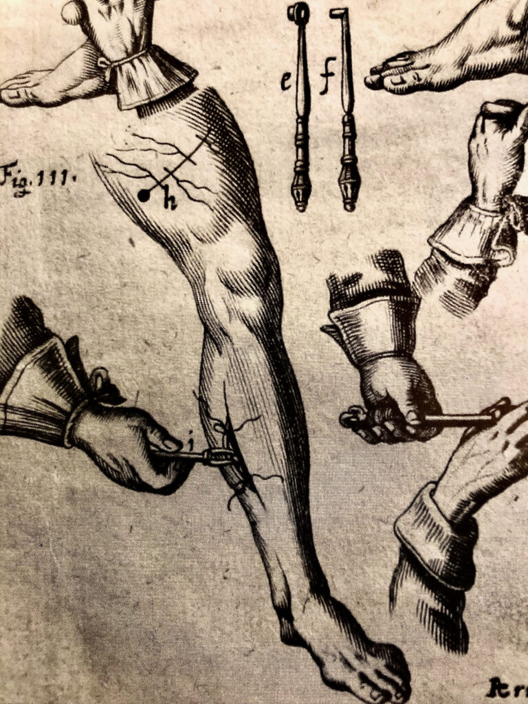 Saphenion®: 115 Jahre Endovenöse Krampfadertherapie