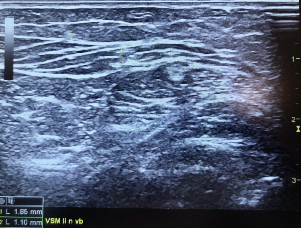 Saphenion® Rostock: Einführung des Venenklebers VenaBlock®