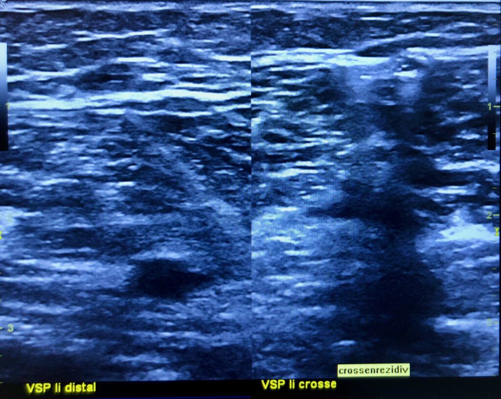 Saphenion® Rostock: Einführung des Venenklebers VenaBlock®