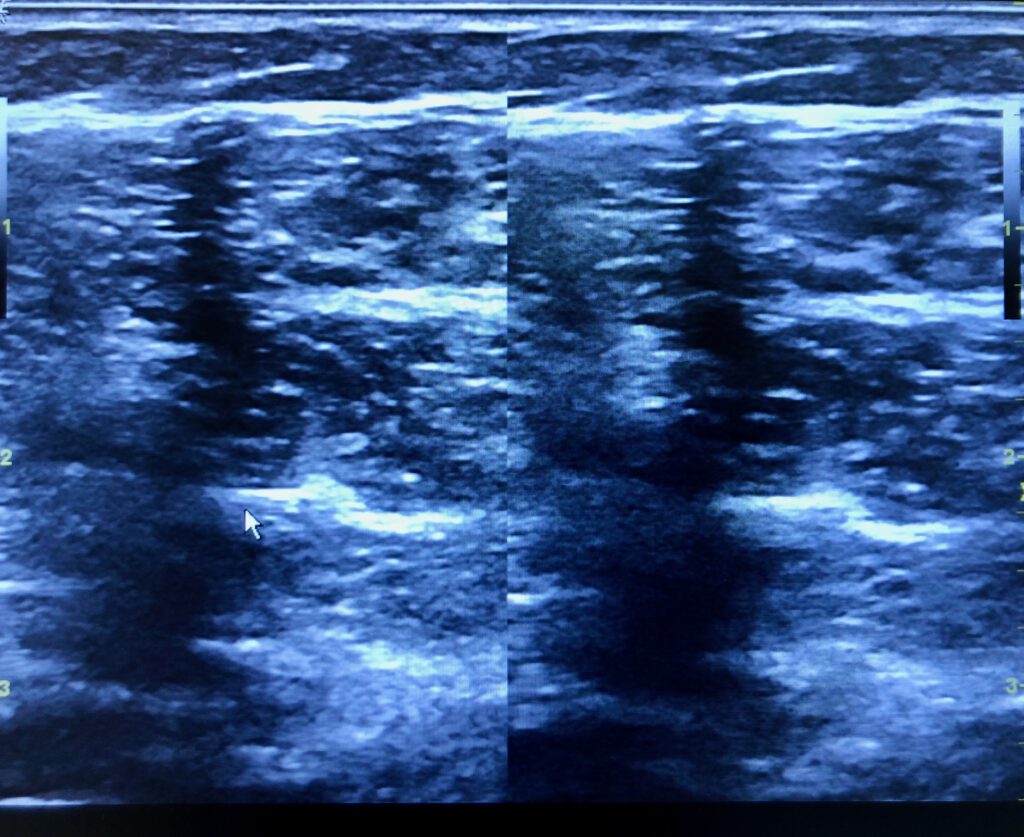 Saphenion® Rostock: Einführung des Venenklebers VenaBlock®