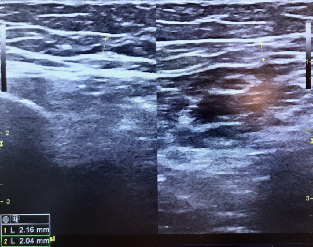 Saphenion® Rostock: Einführung des Venenklebers VenaBlock®