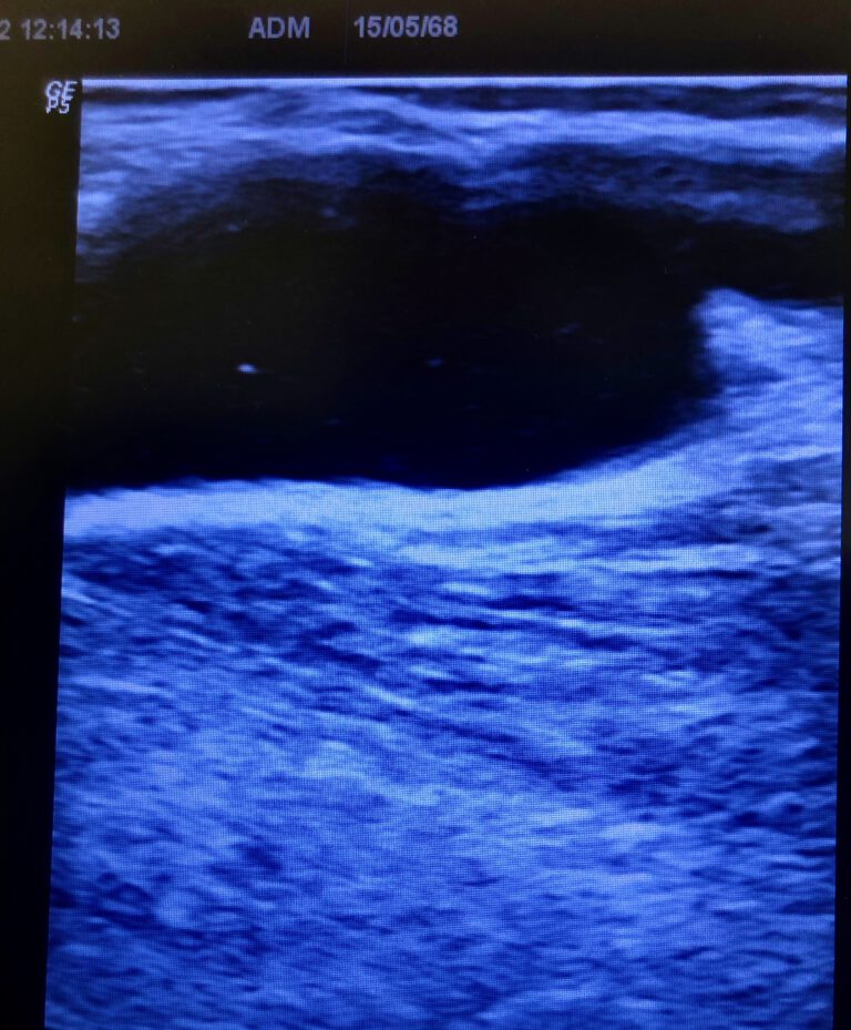 Saphenion®: Therapieprotokoll Bakerzyste - die RFITT-Methode