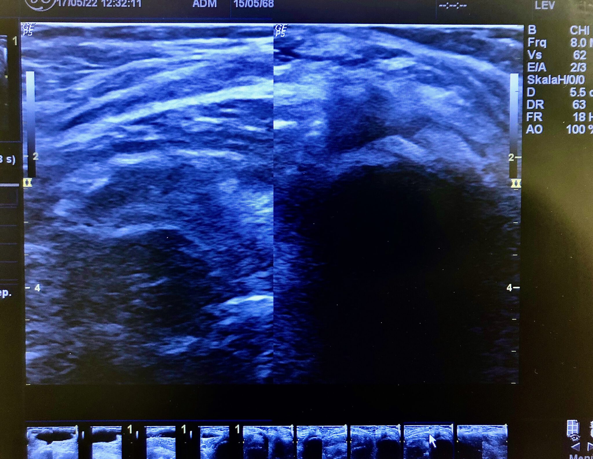 Saphenion®: Therapieprotokoll Bakerzyste - die RFITT-Methode