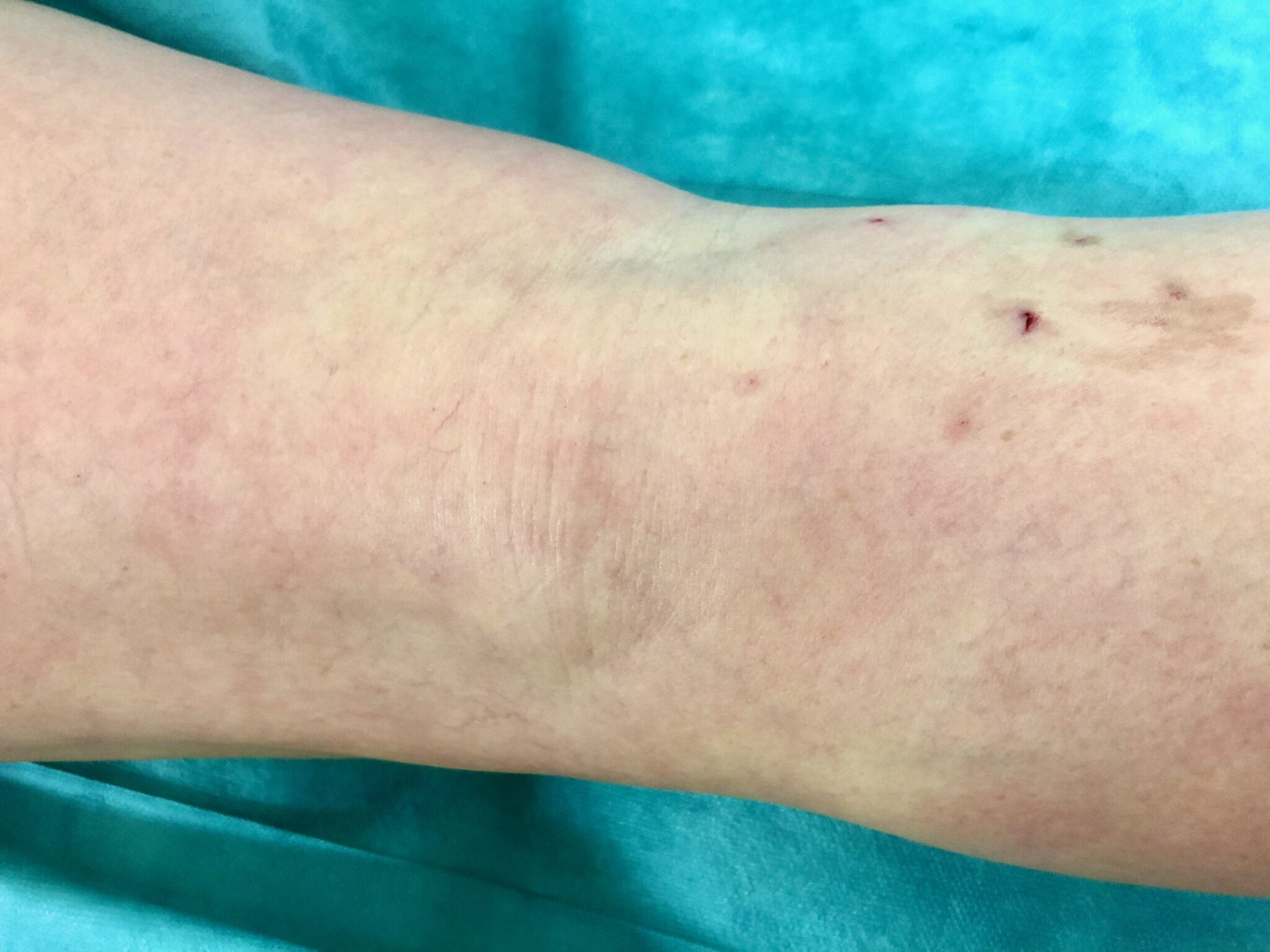 Saphenion®: Therapieprotokoll Bakerzyste - die RFITT-Methode