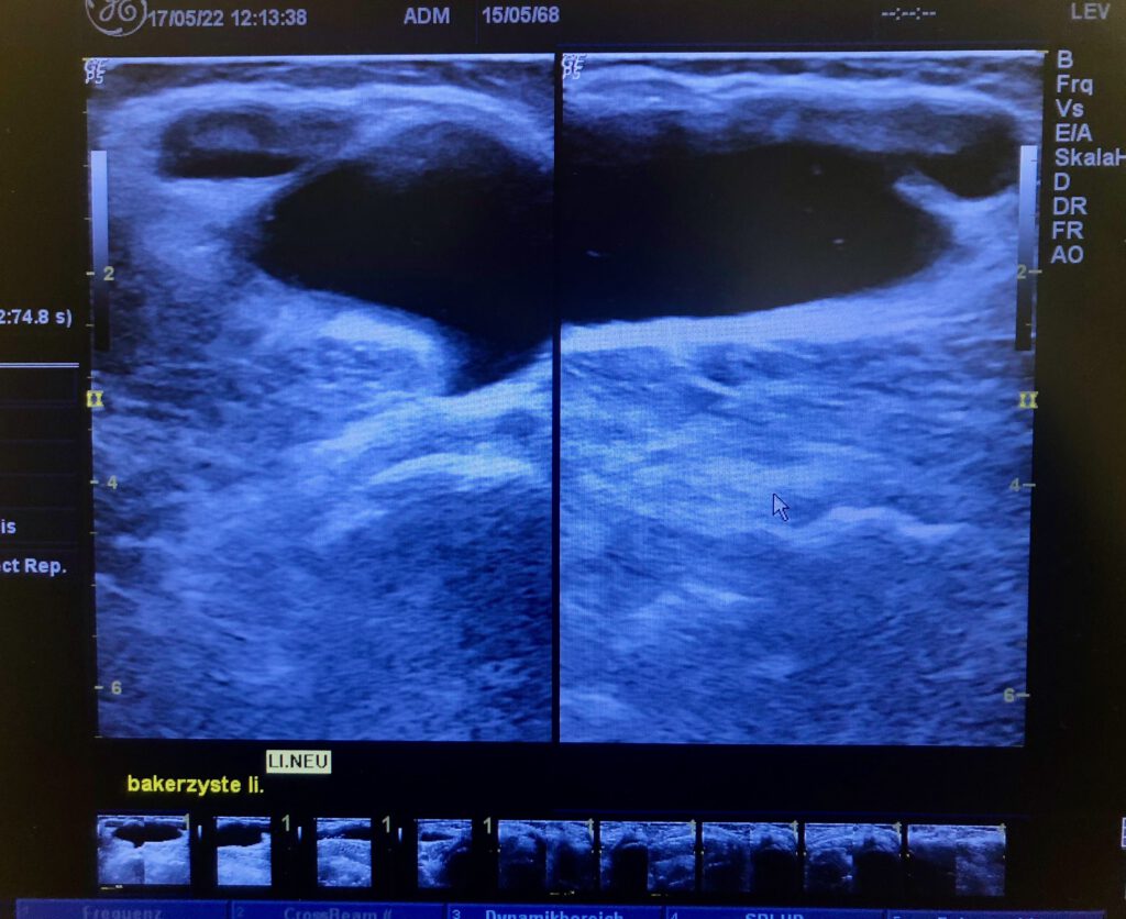Saphenion®: Therapieprotokoll Bakerzyste - die RFITT-Methode